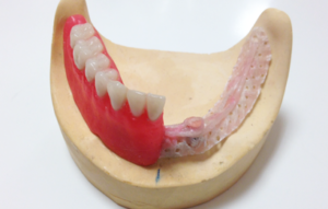 Prothèse Adjointe – Ceramcad – Prothésistes dentaires