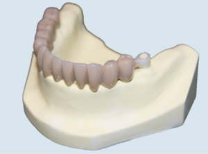 Prothèse Adjointe – Ceramcad – Prothésistes dentaires